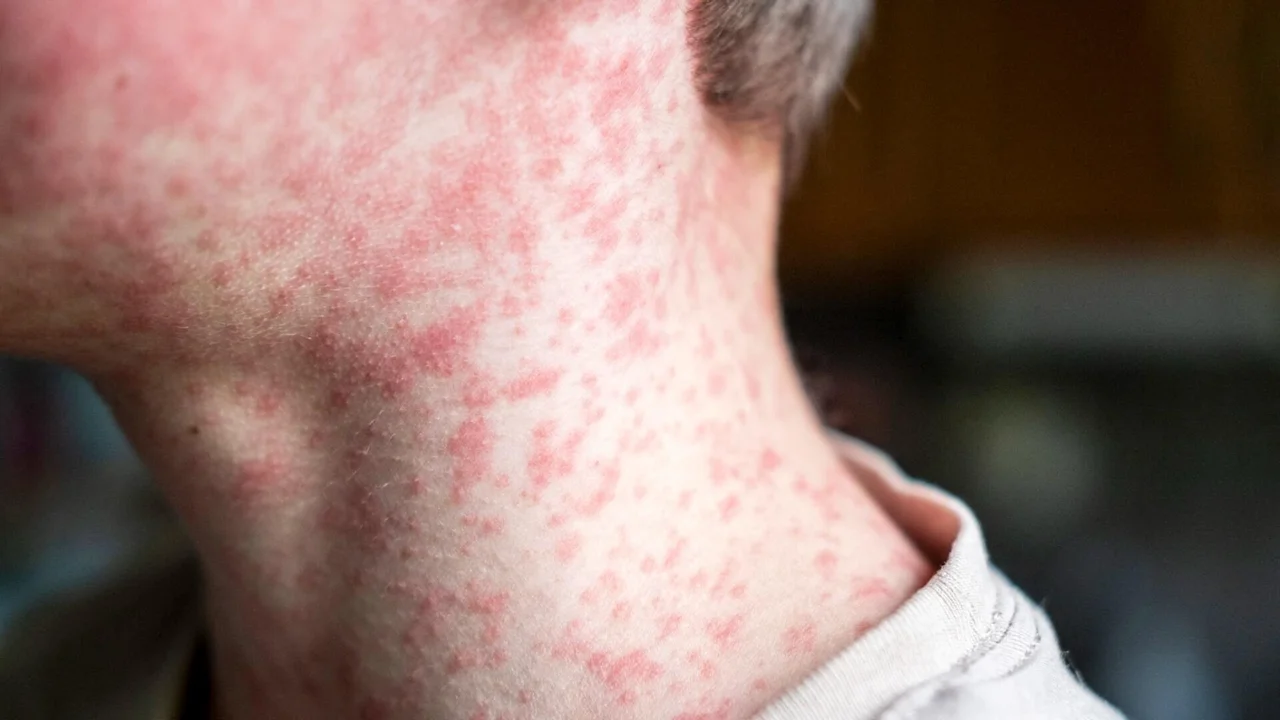 RFK Jr. asks CDC for new measles treatment guidance